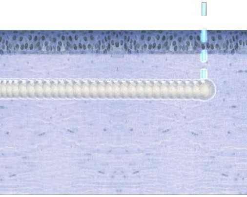 How All-laser Bladeless LASIK is performed?